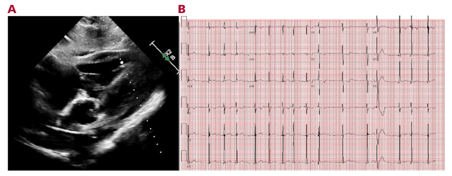 rac - Acute Pericarditis Associated with Graves-Basedow Disease: A Case ...